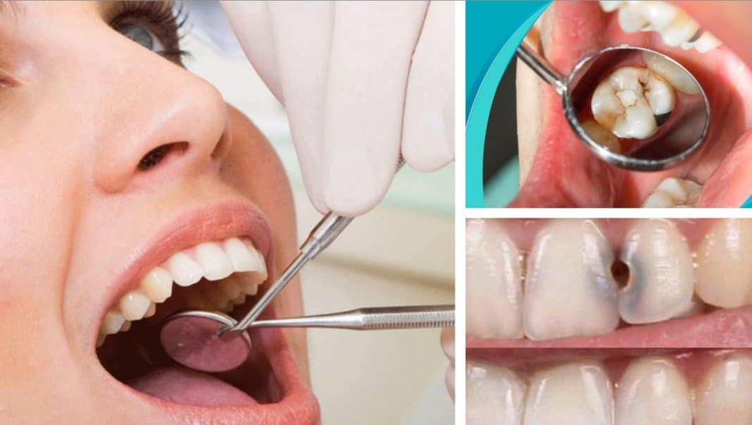 What causes tooth decay? How can it be prevented? - Indigo Magazine